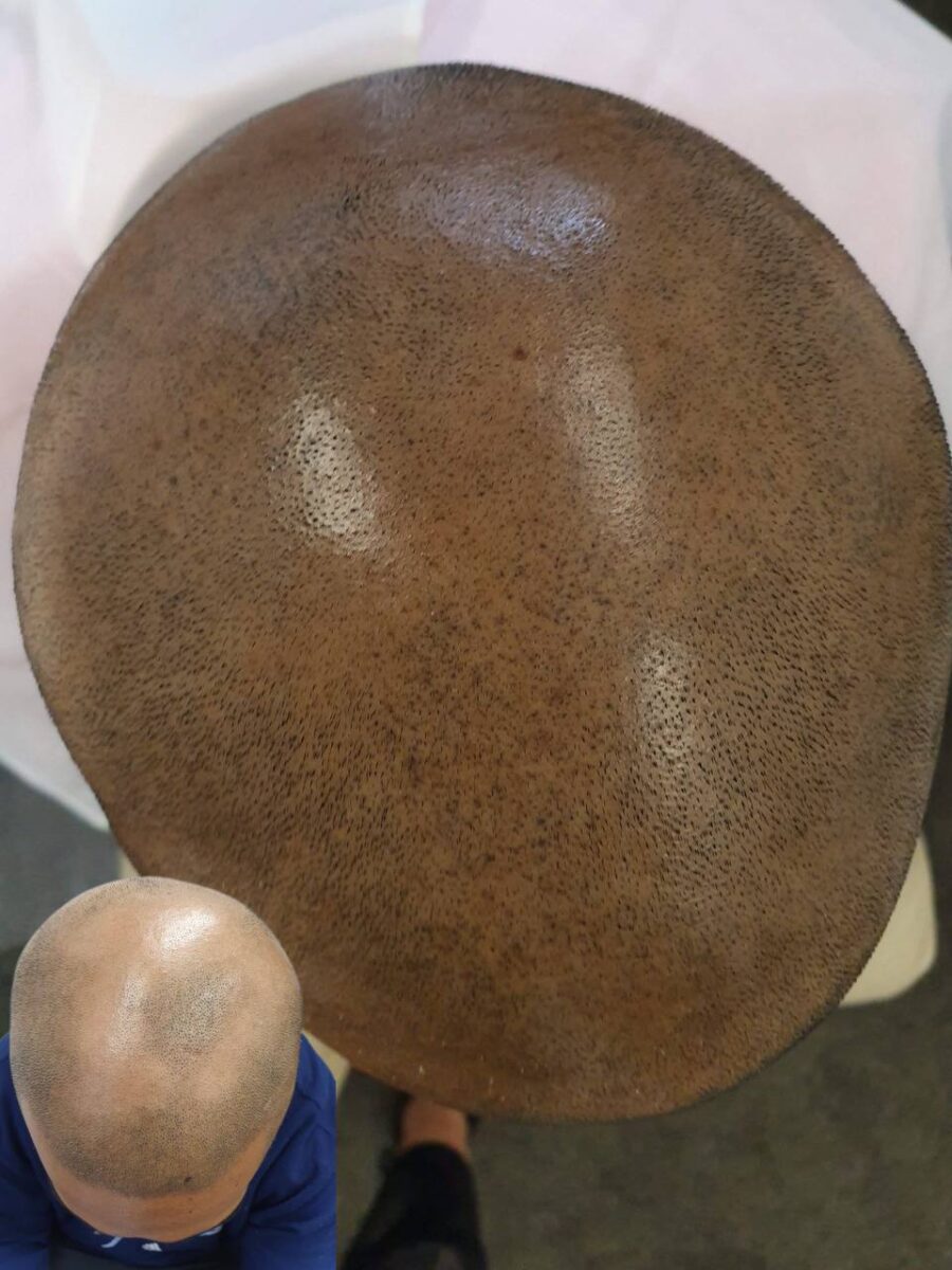 Scalp MicroPigmentation (SMP) | Cosmetic & Medical Tattoo by Dasha