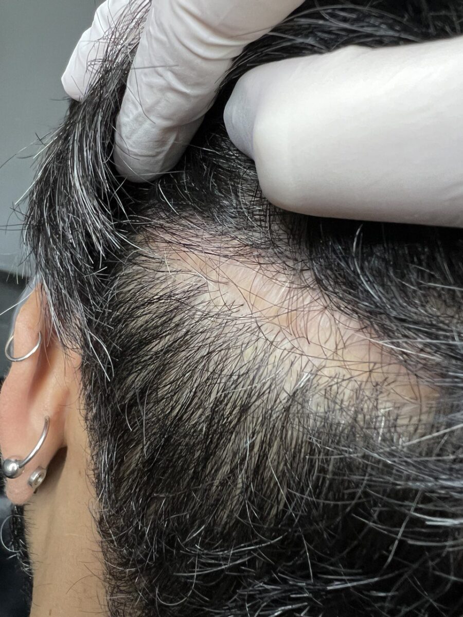 FUT Hair Transplant Camouflage (SMP) | Cosmetic & Medical Tattoo by Dasha