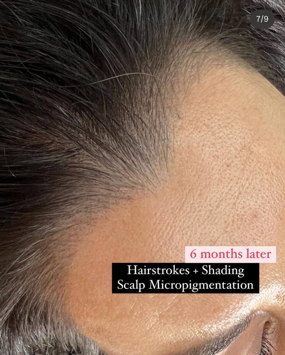 Female Hairline Restoration with Scalp Micropigmentation | Cosmetic ...