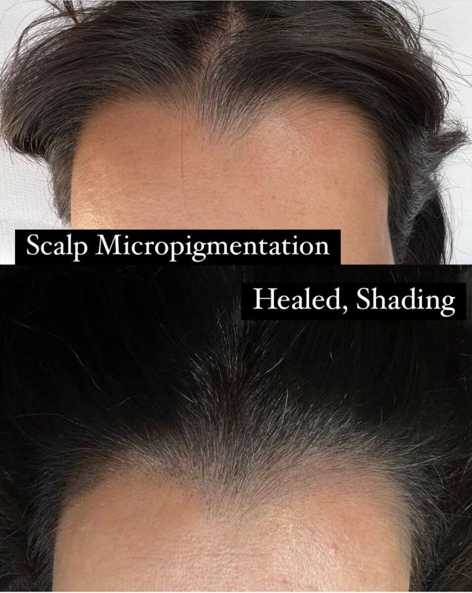 Female Hairline Restoration with Scalp Micropigmentation | Cosmetic ...
