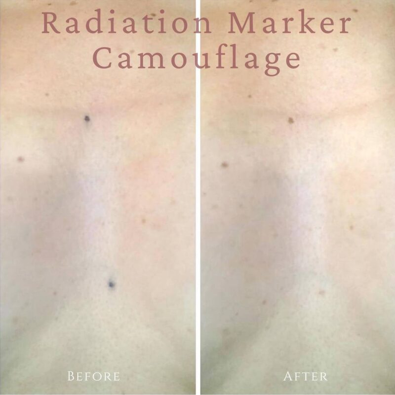 Radiation Marker Camouflage | Cosmetic & Medical Tattoo by Dasha