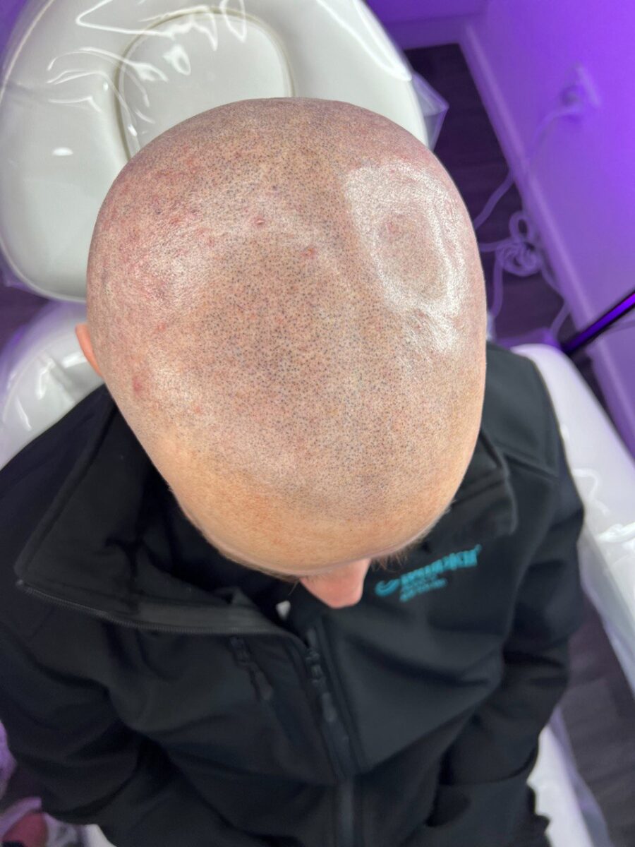 Scalp Micropigmentation SMP | Cosmetic & Medical Tattoo by Dasha